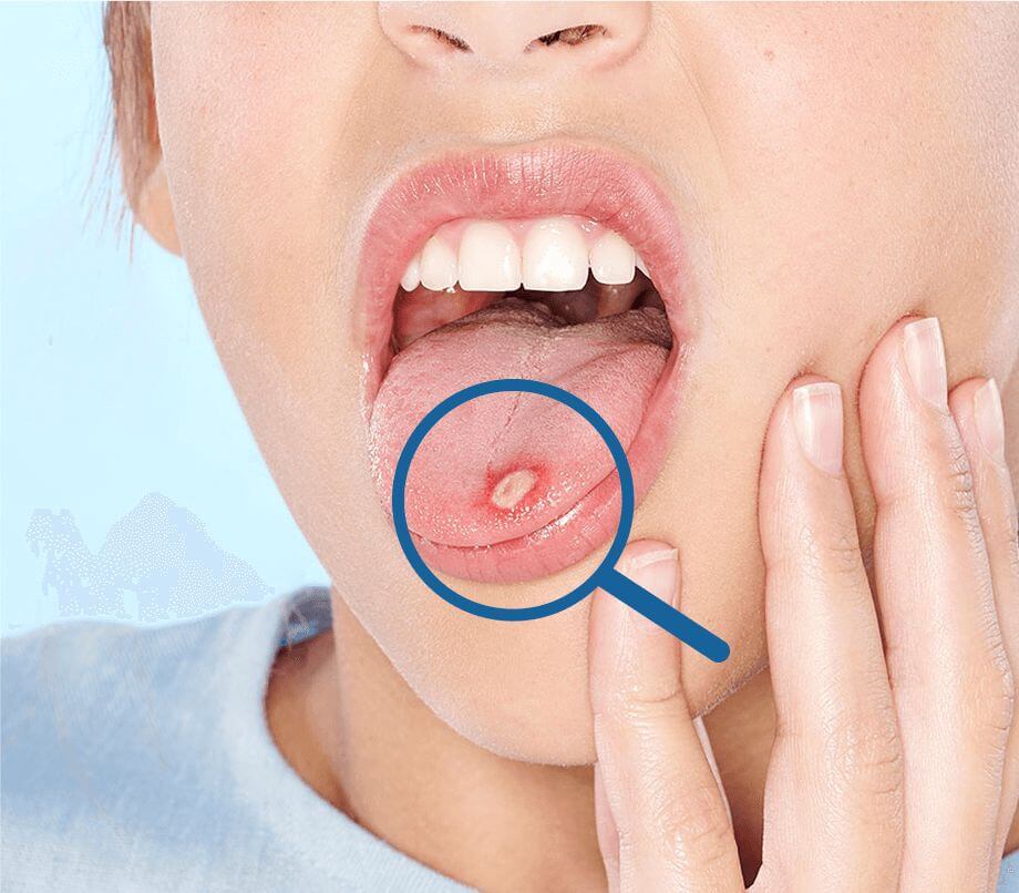 Tipos de aftas - Aloclair PLUS